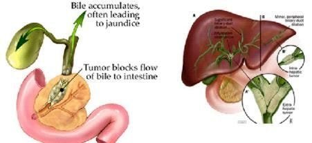 Bile Duct Cancer - Symptoms, Life Expectancy, Prognosis